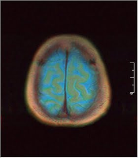 Nevit's blog: False-color Brain MRI (Motion artifacts)