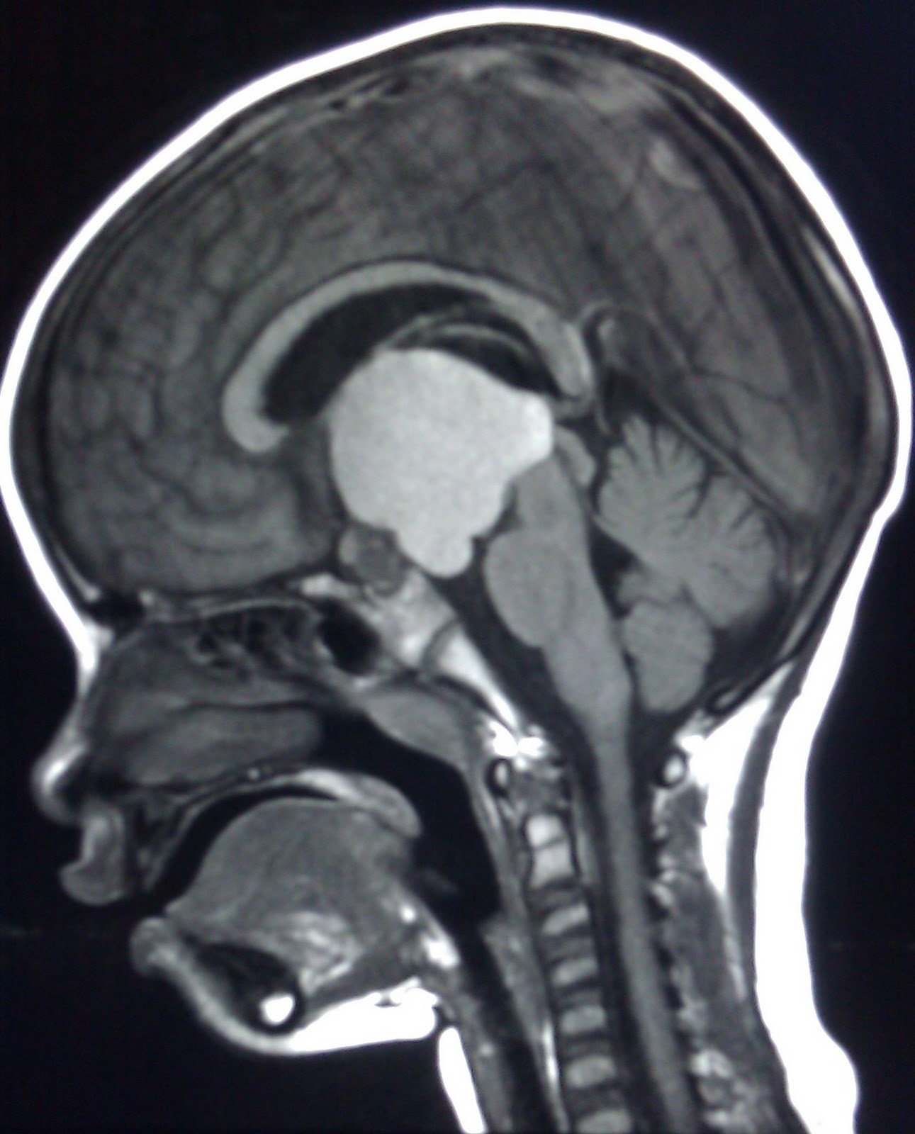 Craniopharyngioma; Craniopharyngioma, Adamantinous; Craniopharyngioma ...
