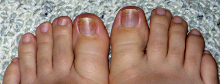 What causes dark toenails - Awesome Nail