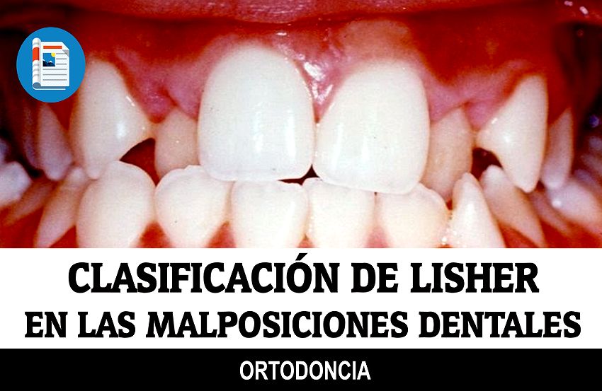 ORTODONCIA: Clasificación de Lisher en las Malposiciones Dentales