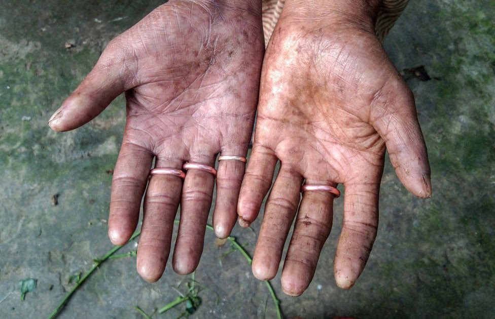 TYWKIWDBI ("Tai-Wiki-Widbee"): Adermatoglyphia