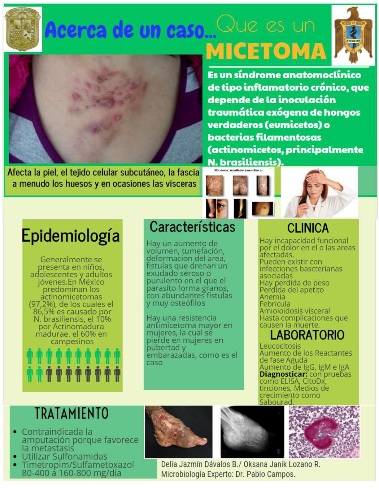 DIVULGACIÓN CIENTÍFICA UG: ¿Que es un Micetoma?