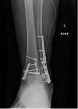 Case of the Month: Fracture cases at Harborview Medical Center ...