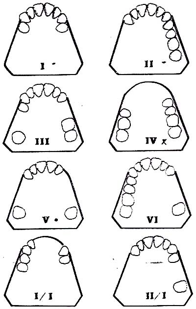 Stu-DENT Diaries: Removable Partial Denture Design