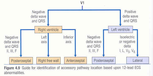 Pedi cardiology: EP, EKG:WPW - Locating accessory pathway