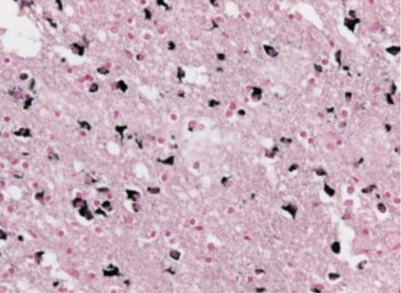 Prions — Definition, Diseases, Structure and diagnosis