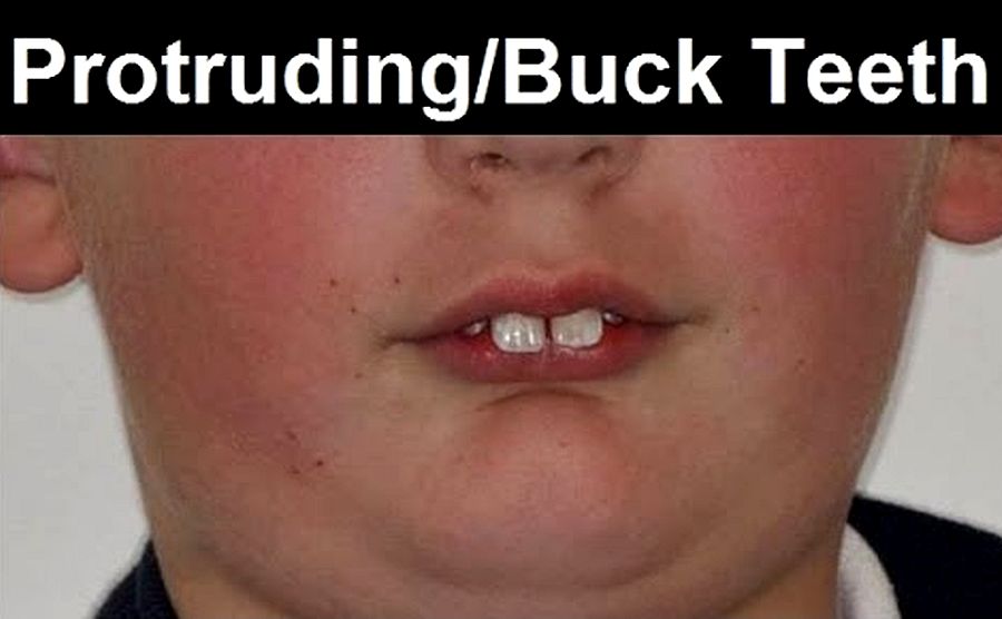 ORTHODONTICS: What Causes Protruded Teeth, Buck Teeth, Frontal Teeth ...