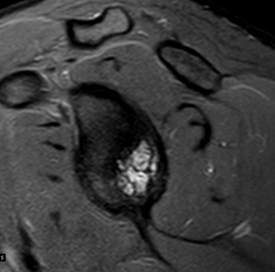 Glenoid Subchondral Cystic Lesion -Approach. - Sumer's Radiology Blog