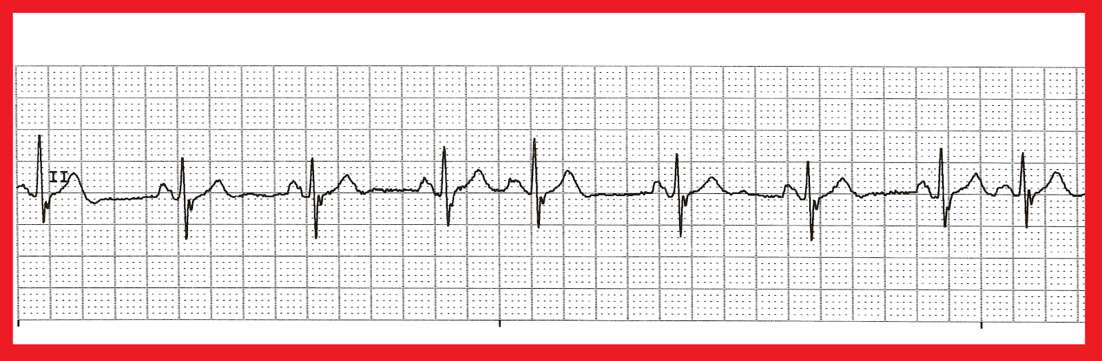 EKG Rhythm Quiz 274
