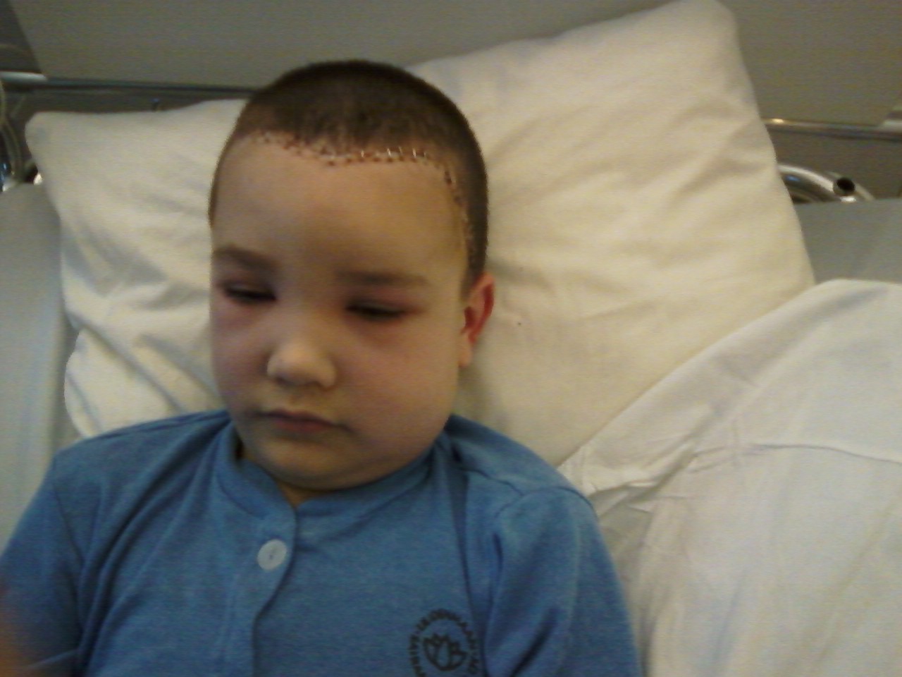 Epilepsia epistä.: Haava