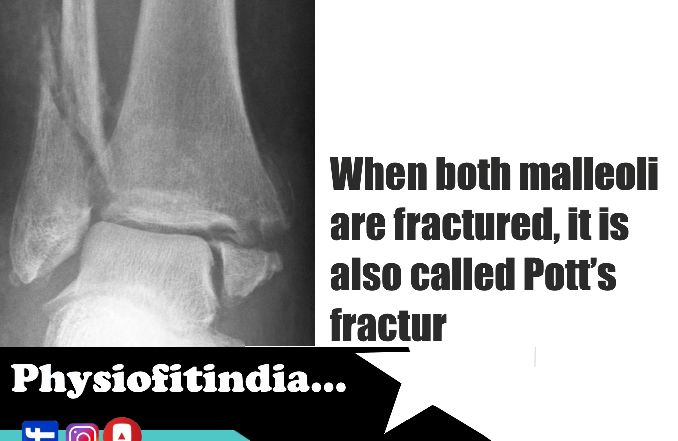 Anklen Fracture Classification, Complications ,Physiotherapy management