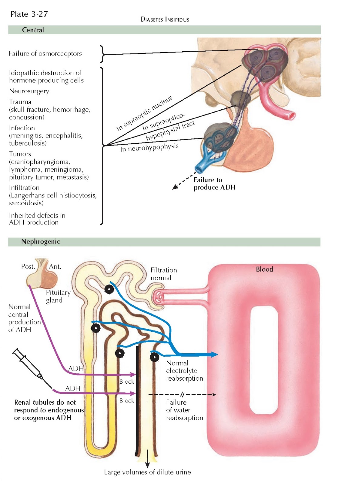 NEPHROGENIC DIABETES INSIPIDUS - pediagenosis