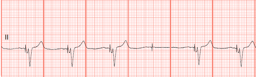 Float Nurse: EKG Quiz 363
