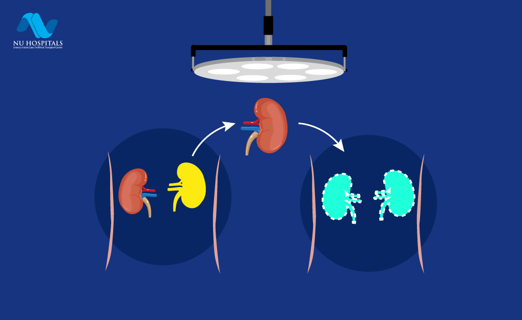 NU Hospitals: Kidney Biopsy Tests: Procedure, Risks & Results NU Hospitals: Kidney Biopsy Tests: Procedure, Risks & Results