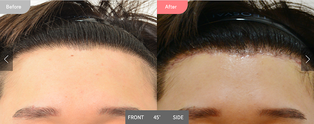 [ATOP Plastic Surgery Korea] Forehead Reduction (Forehead shortening ...