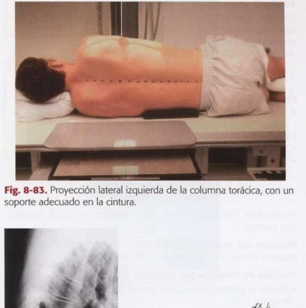 PROYECCION LATERAL DE COLUMNA TORÁCICA