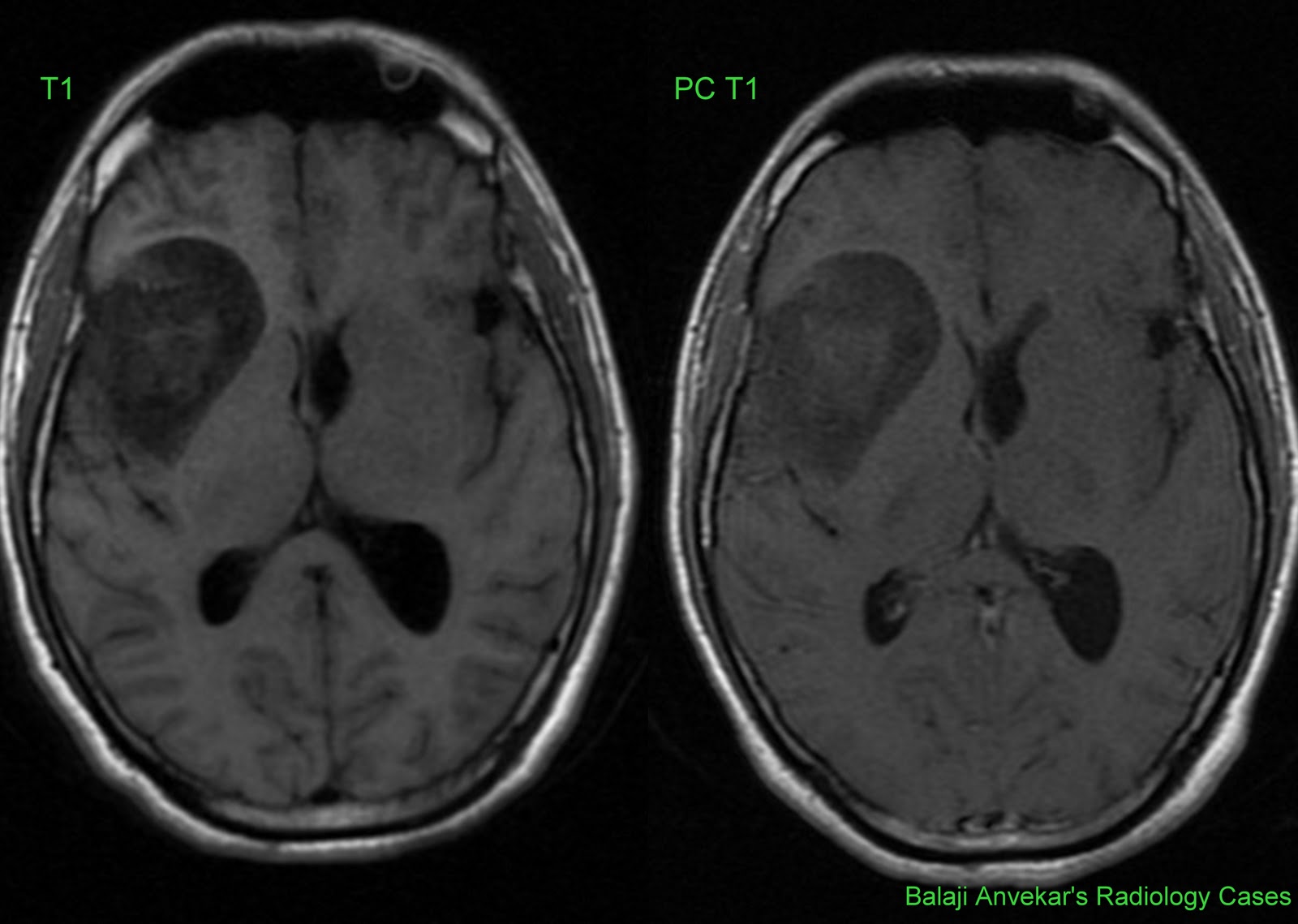 Dr Balaji Anvekar FRCR: Anaplastic Astrocytoma MRI