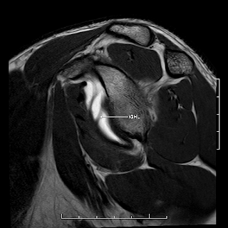 MR Arthrography Shoulder - Sumer's Radiology Blog