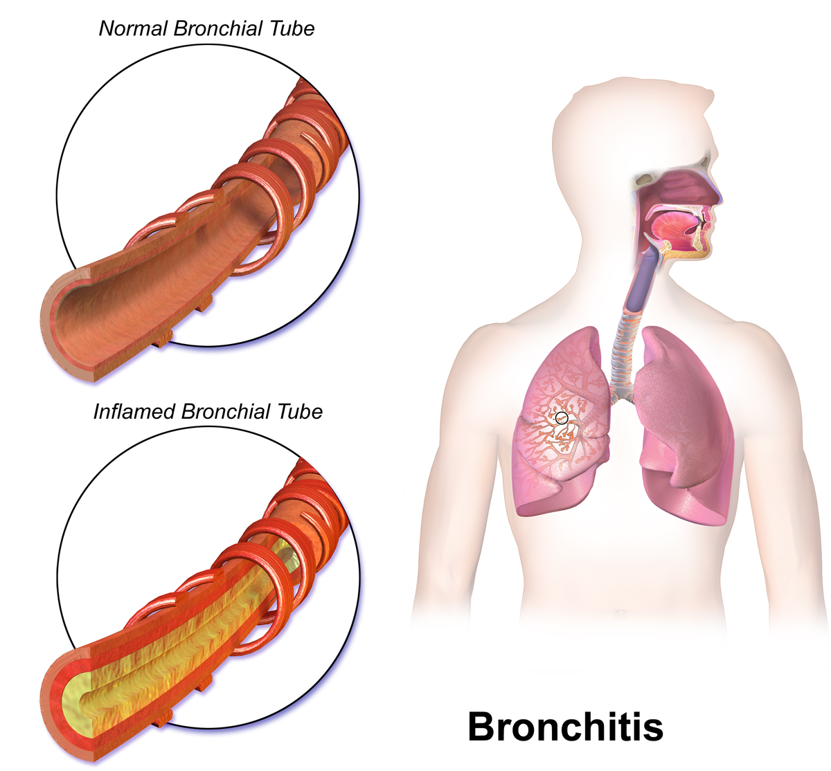 Perbedaan Terapi Pada Bronkitis (Bronchitis) Akut dan Kronis - Cardoetz