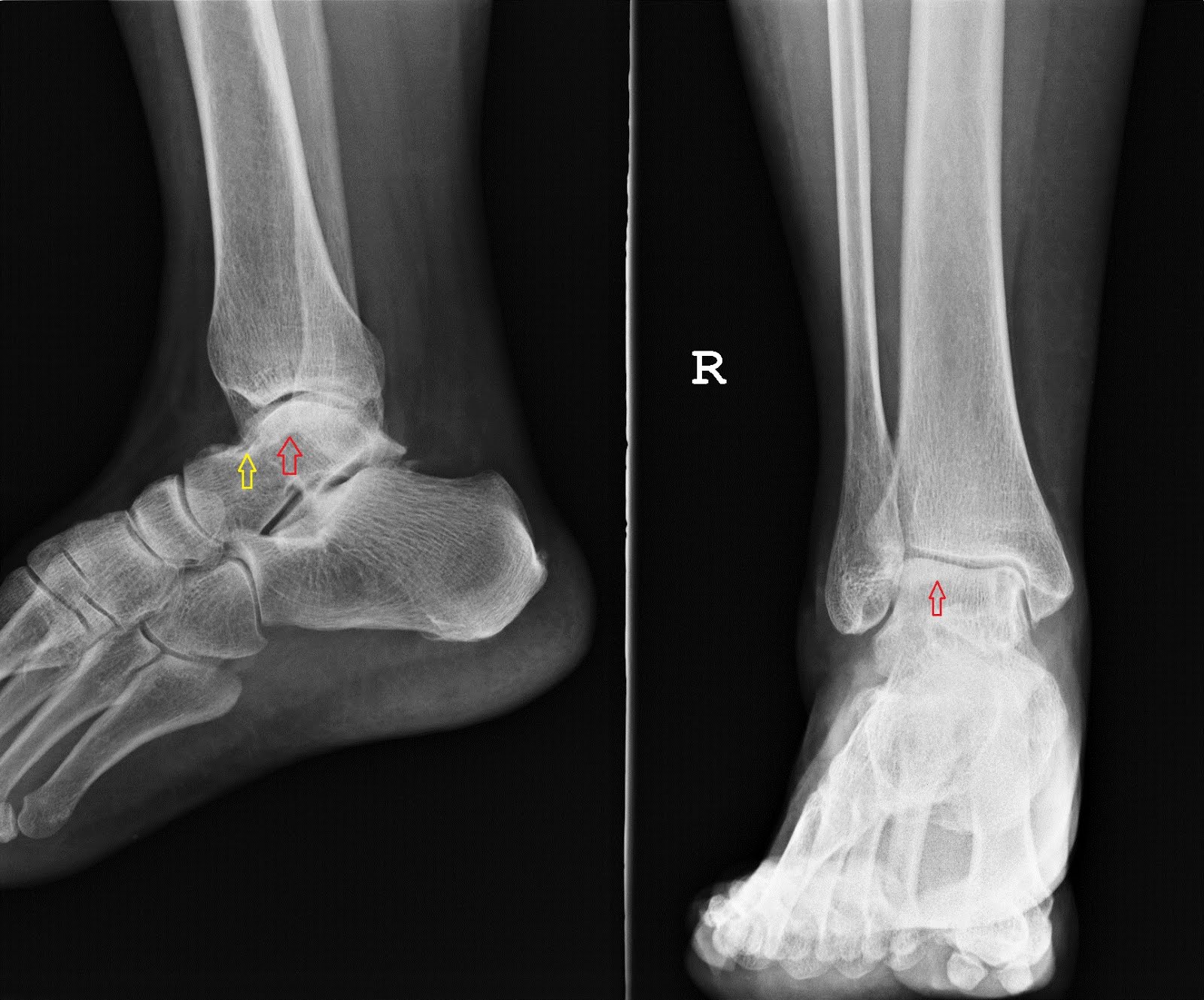 PPS Radiographs