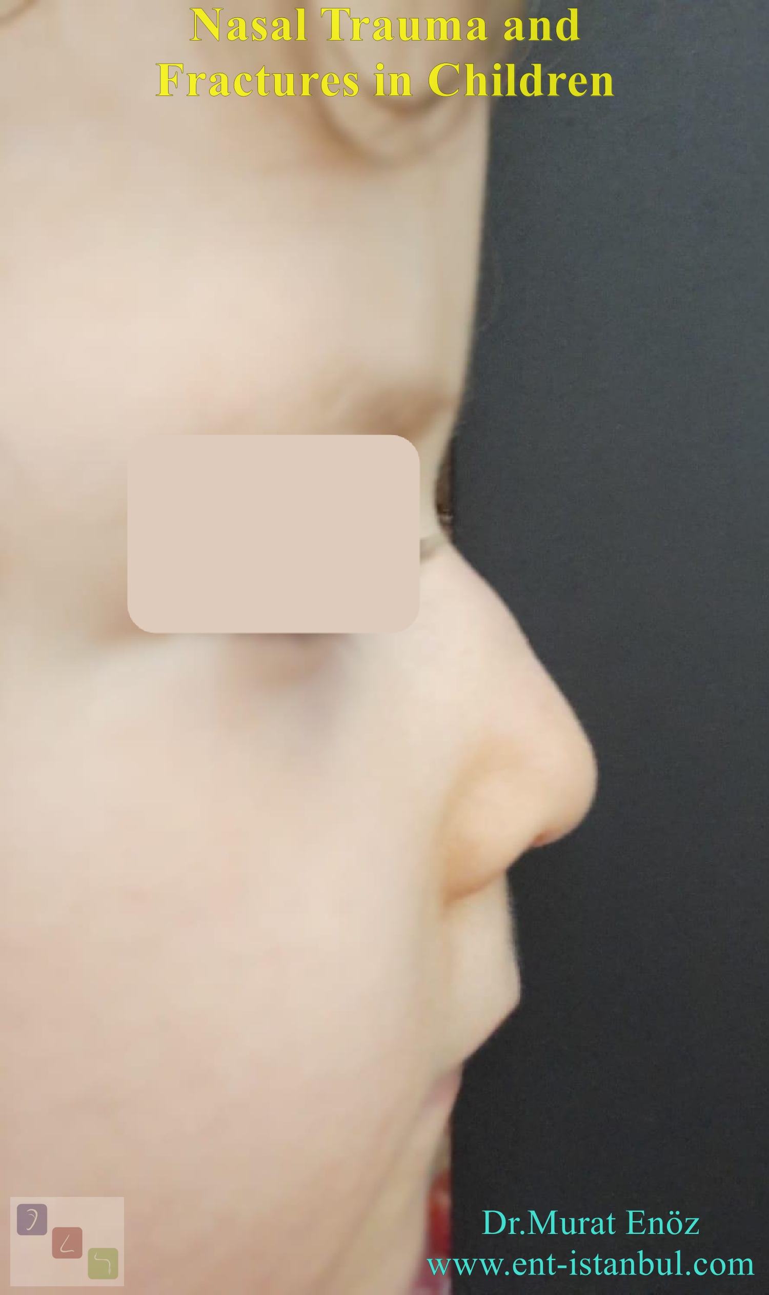 Nasal Fractures - Causes, Symptoms, Diagnosis, Treatment