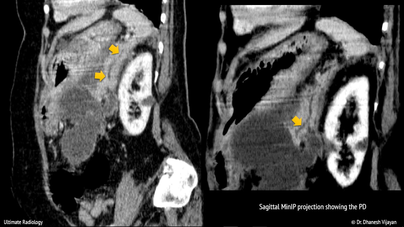 Ultimate Radiology : Pancreatic pseudocyst with duct communication (CT)