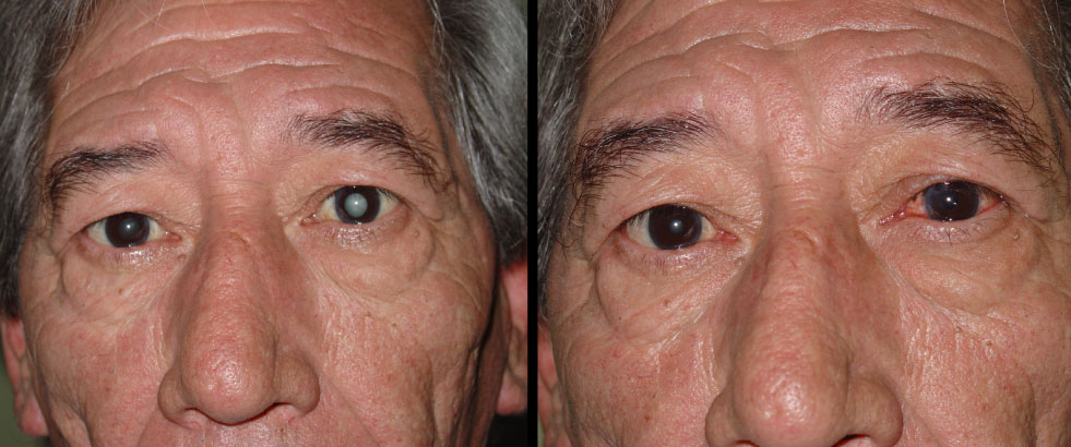 problemas de los ojos con la edad,las cataratas - epharmco - salud