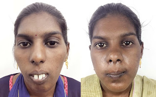 CHIN AUGMENTATION - Richardson dental and craniofacial Hospitalposts