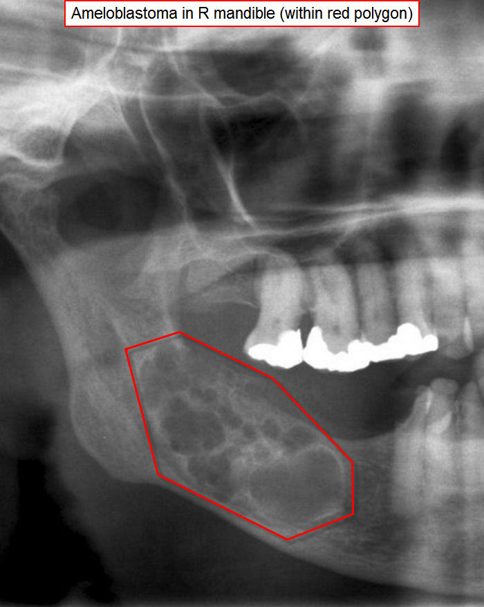 WizDent: Ameloblastoma showing multilocular radilolucency
