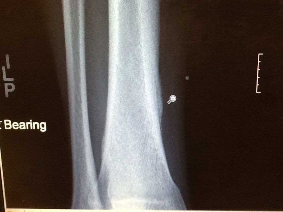 Foot and Ankle Problems By Dr. Richard Blake: Leg Pain in a Runner ...