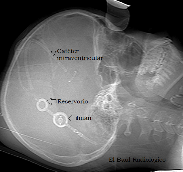 El Baúl Radiológico: VÁLVULAS DE DERIVACIÓN VENTRÍCULO-PERITONEAL ...