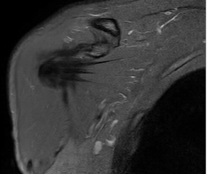 Acromioclavicular junction injury-MRI - Sumer's Radiology Blog