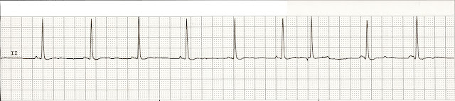 EKG Rhythm Strip Quiz 57: Ectopic Beats