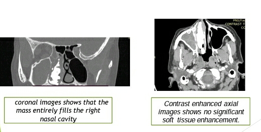 A RARE CASE OF LARGE RHINOLITH IN AN ADULT