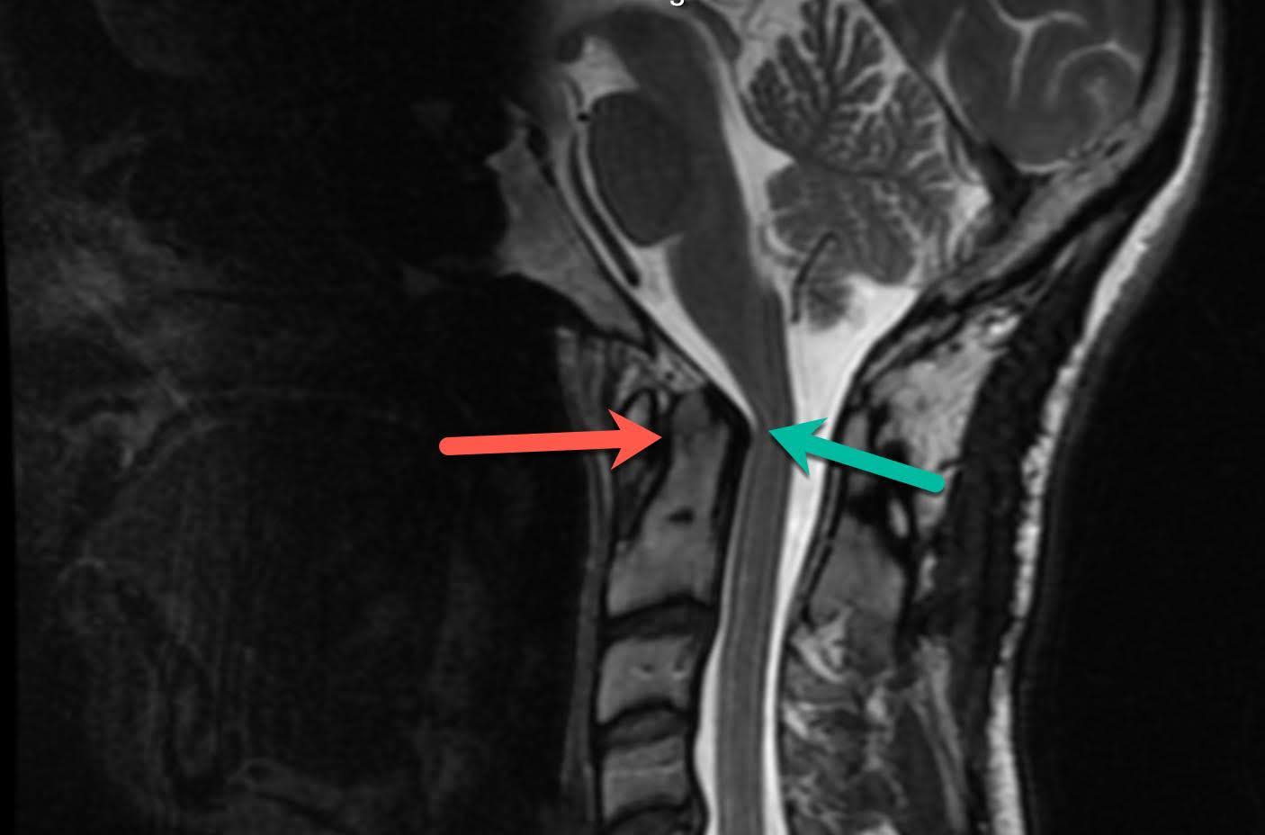 ...but maybe tomorrow: An old C2 fracture, more procedures, nTOS consult