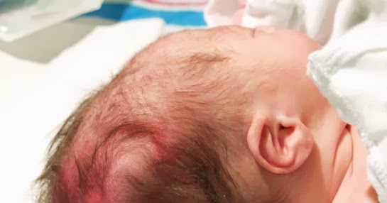 WELCOME TO MY BLOGGER: CAPUT SUCCEDANEUM