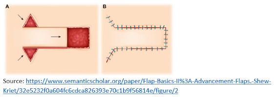 OHIMA Blog: Coding for Adjacent Tissue Transfers