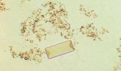 Atlas of Crystals found in alkaline urine | Free Medical Atlas