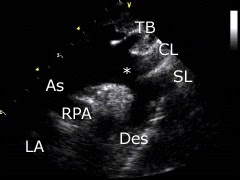 Phimaimedicine: 1,180. Suprasternal view echocardiography