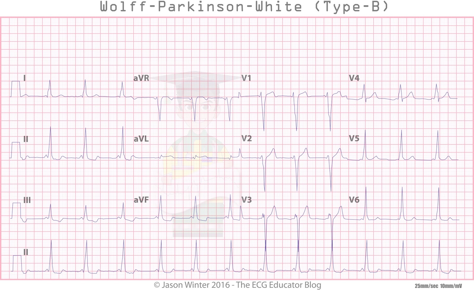 ECG Educator Blog : Wolff-Parkinson-White