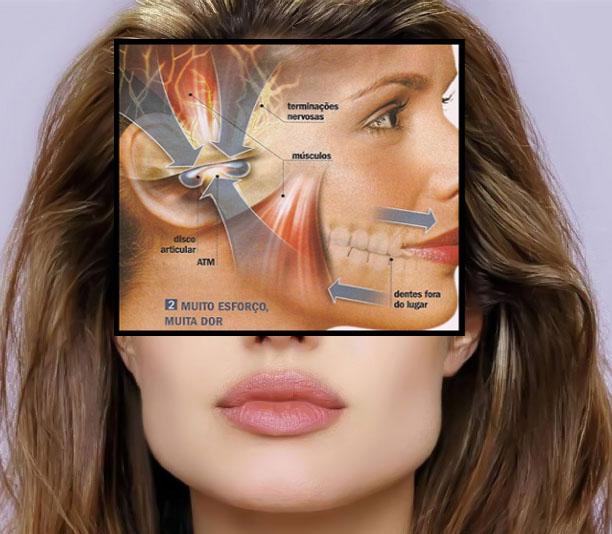 Moz Moda: Desenvolvimento do músculo Masseter