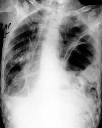 RADIOLOGY IMAGE SPOTTERS: Eventration left hemidiaphragm