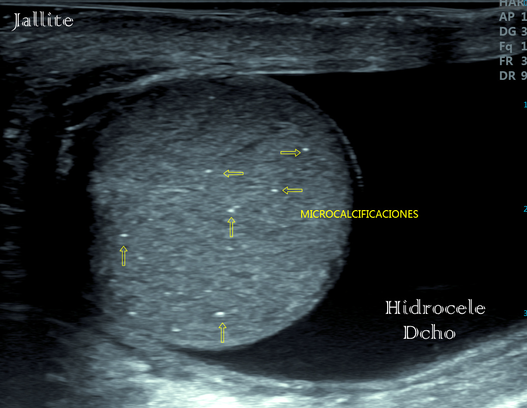 Hidrocele Post-Trauma