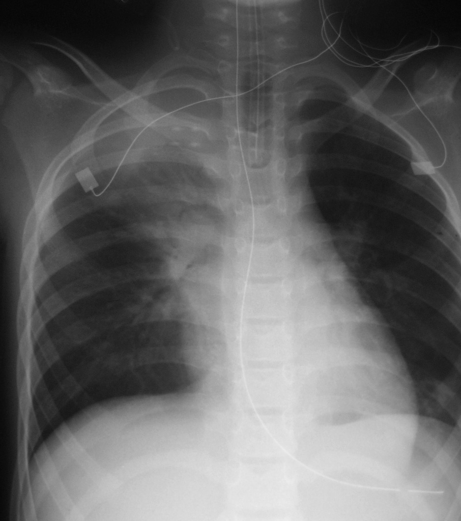 New Patient Post Intubation Cxr