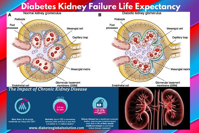 2020 Diabetes Kidney Failure Life Expectancy | Stage 5 4 3 2