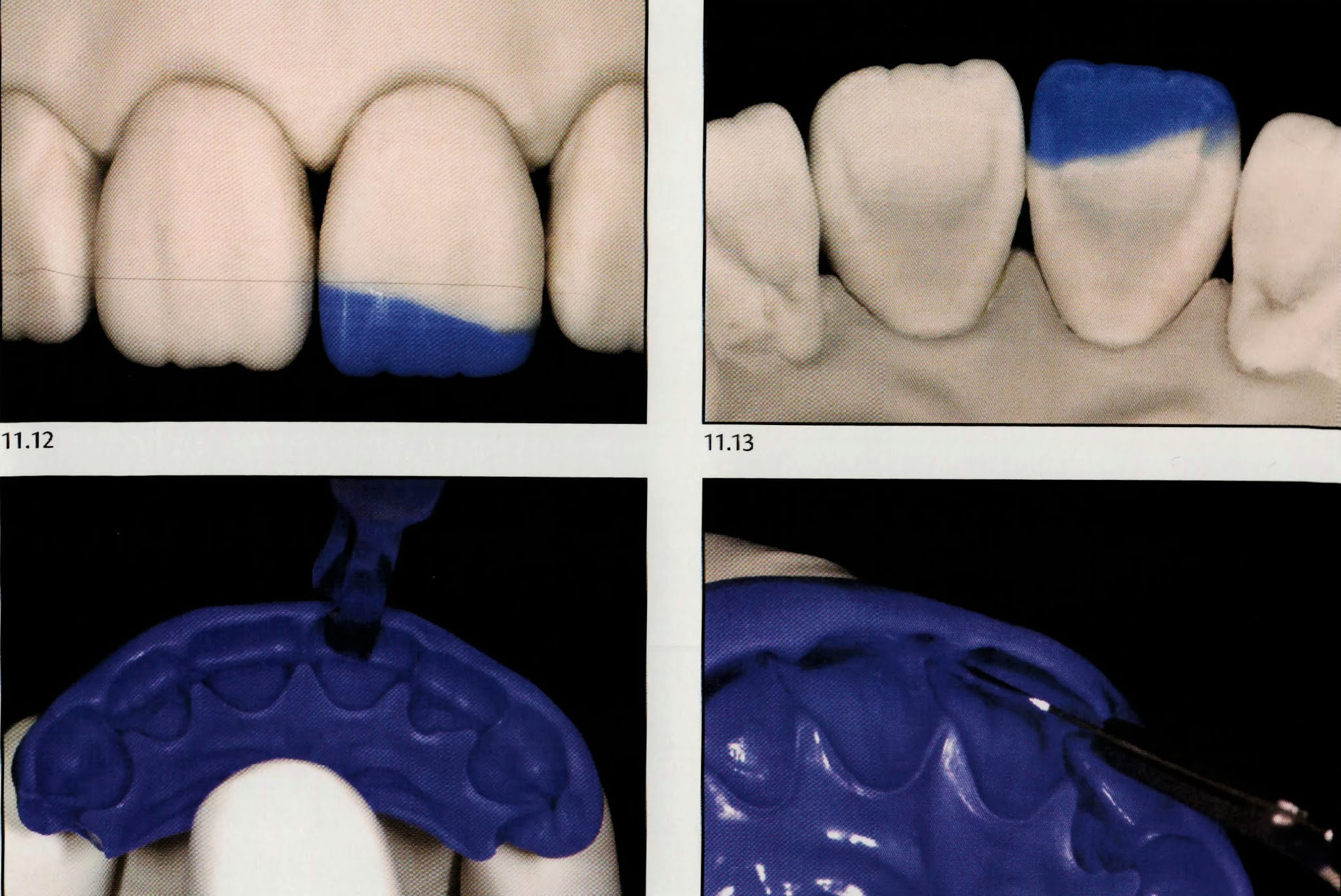 Class IV composite " silicone guide technique " | Dental Esthetics