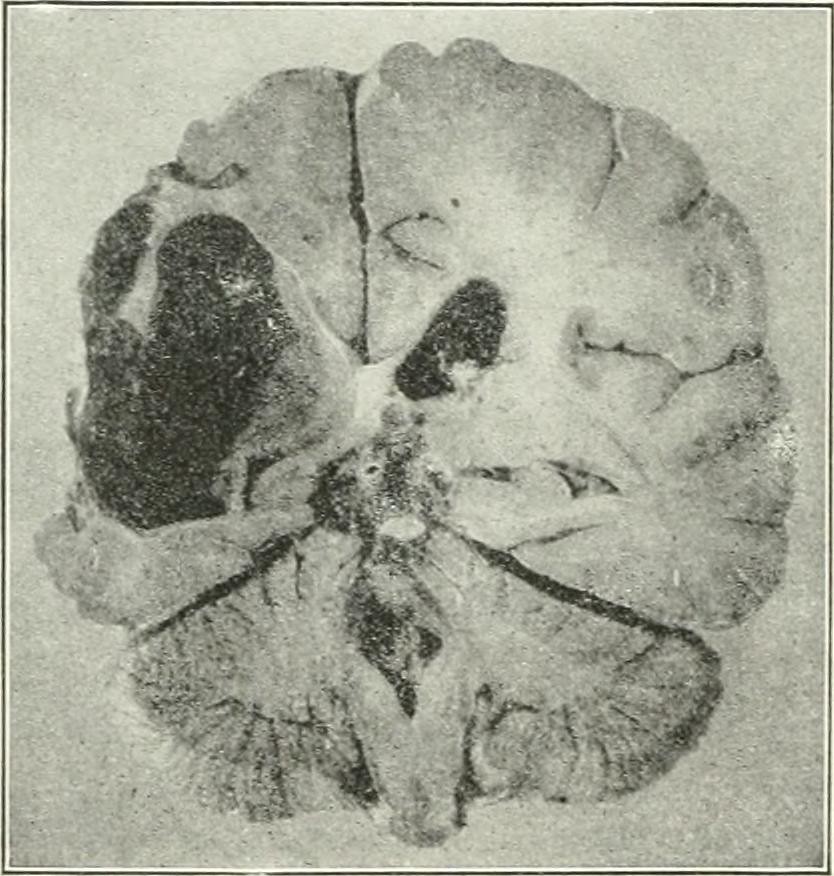 The Tales of a Stroke Patient and More: Stroke Survivors Like Us With ...