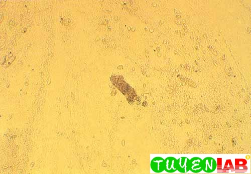 Atlas of Casts in urine | Free Medical Atlas