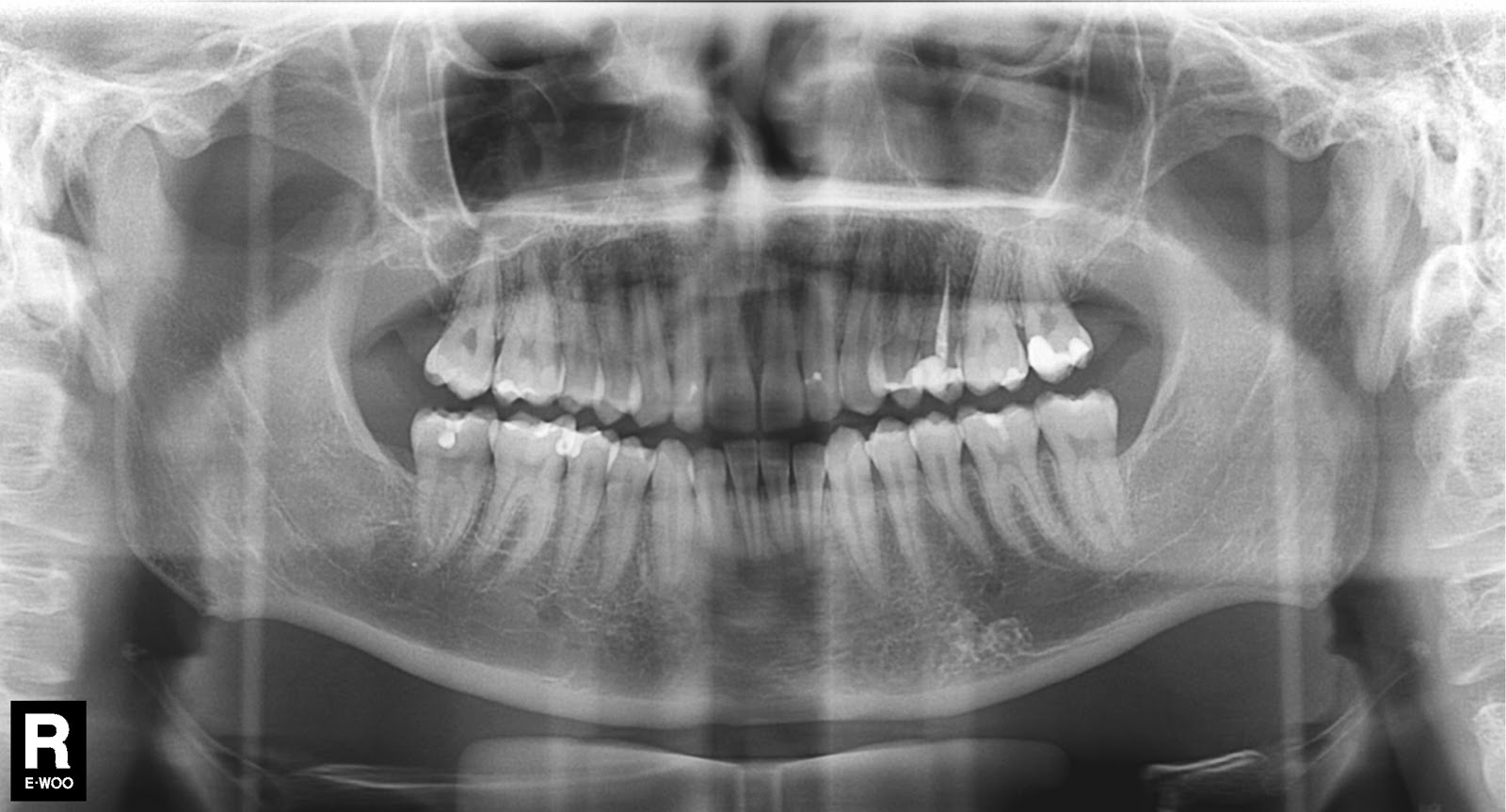 Orthopantomogram Opg