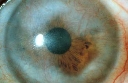 Photos For Herpes Simplex Keratitis (HSK) - Dendritic Corneal Ulcer ...